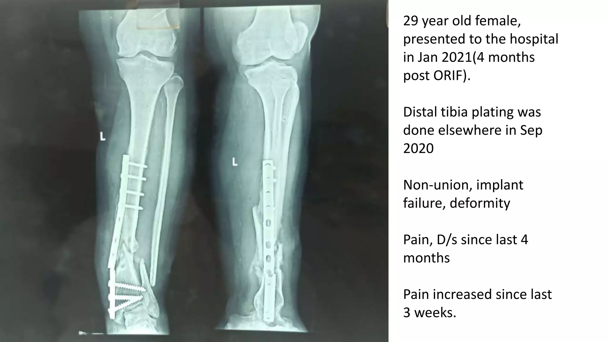 Tibia non union.pptx