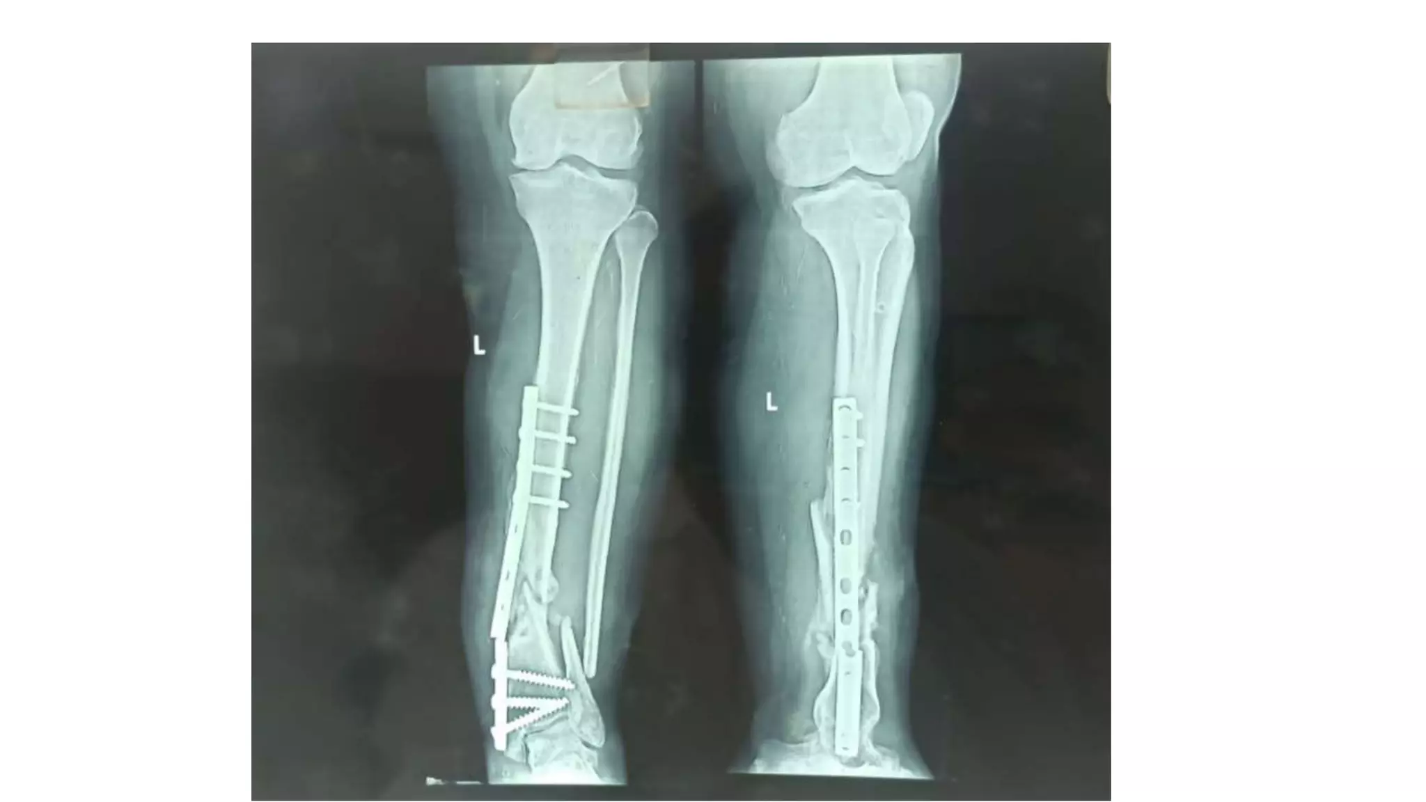 Tibia non union.pptx