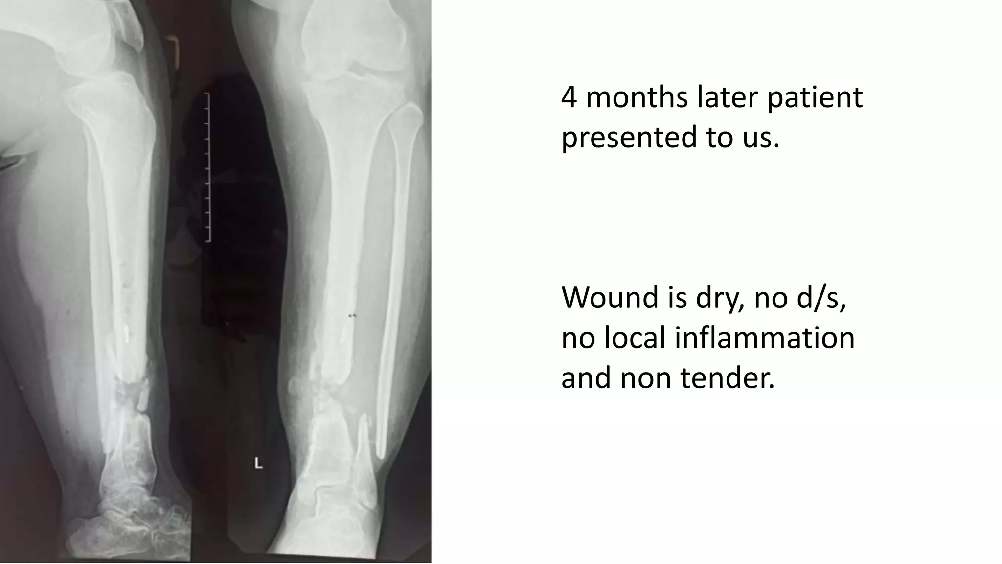 Tibia non union.pptx