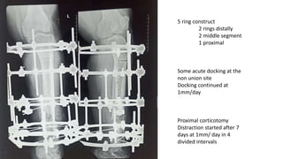 Tibia non union.pptx