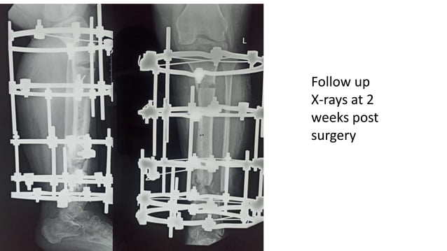 Tibia non union.pptx