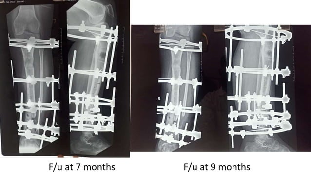 Tibia non union.pptx