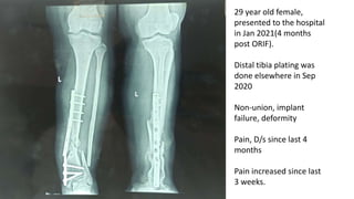 Tibia non union.pptx