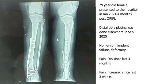 Tibia non union.pptx