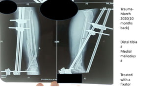 Tibia non union.pptx