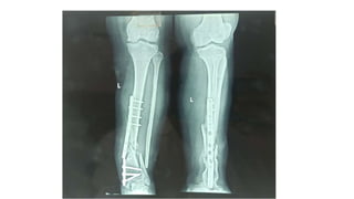 Tibia non union.pptx