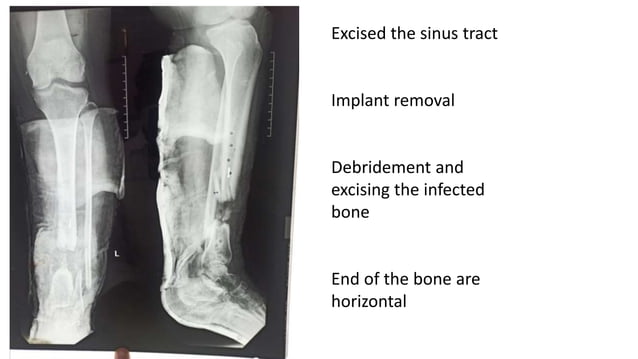 Tibia non union.pptx | Free Download