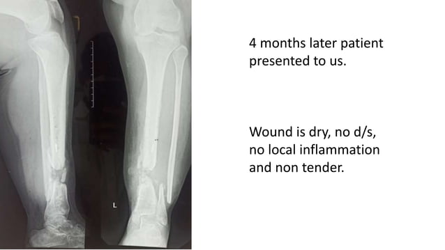 Tibia non union.pptx