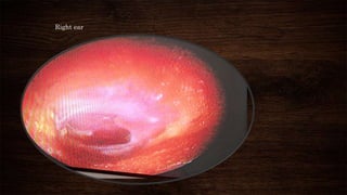 Ear Case presentation.pptx