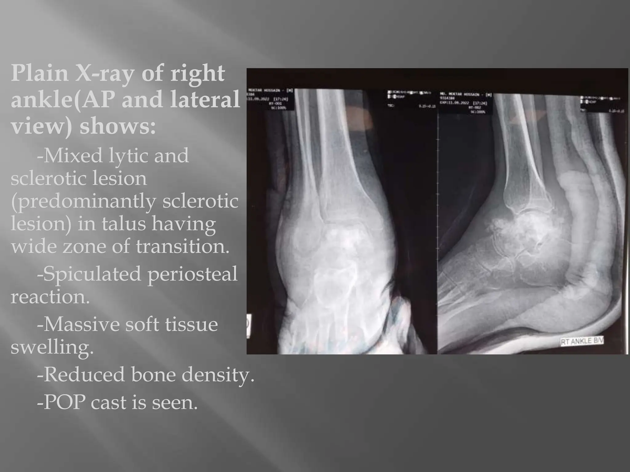 Osteosarcoma | PPTX | Bone and Joint Conditions | Diseases and Conditions