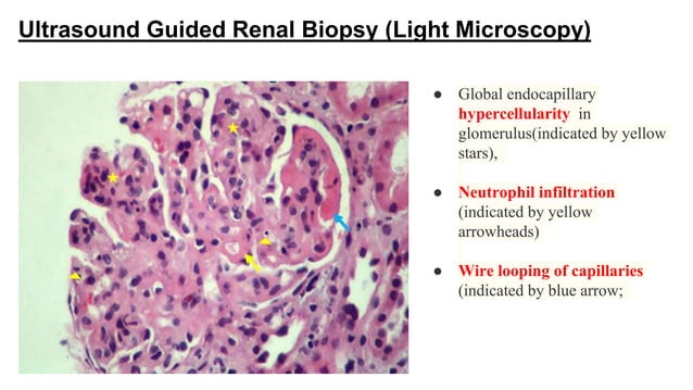 Case Presentation.pptx Lupus nephritis is inflammation and damage in your kidneys due to ...