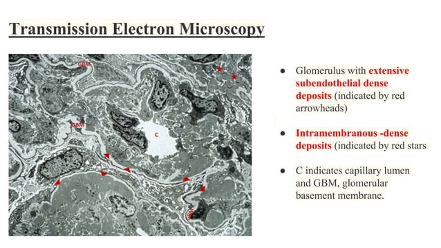 Case Presentation.pptx Lupus nephritis is inflammation and damage in your kidneys due to ...