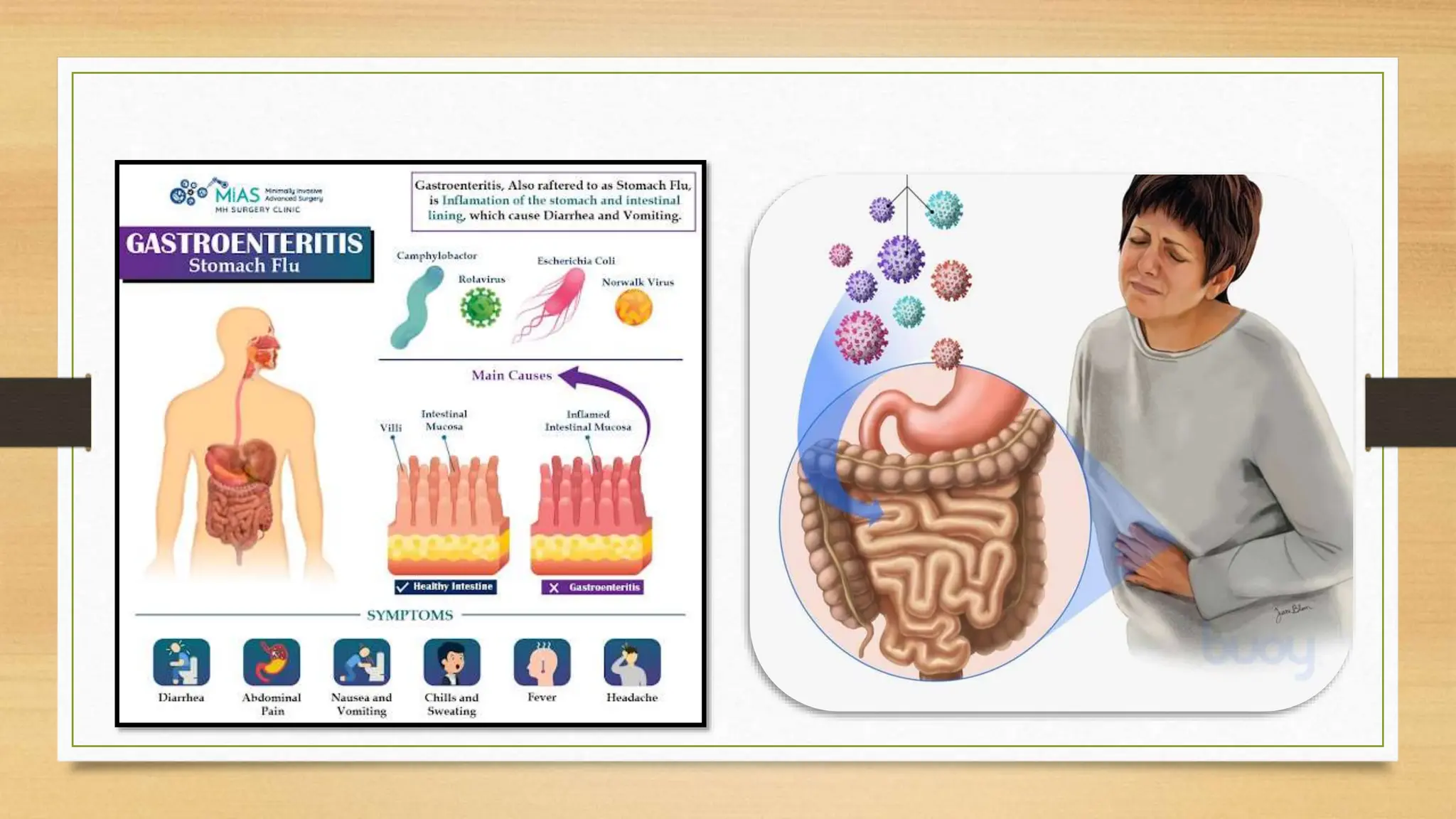 CASE PRESENTATION ON ACUTE GASTROENTERITIS. | PPTX