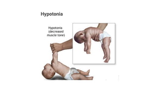 Hypotonia Presentation (case presentation) | PPTX