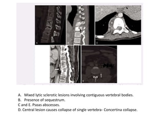 Case presentation of pulmonary tuberculosis x- ray finding | PDF