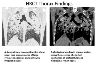 Case presentation of pulmonary tuberculosis x- ray finding | PDF