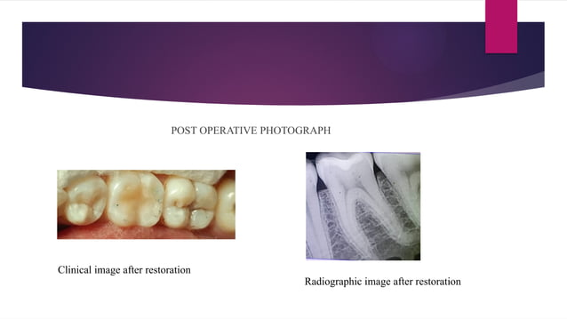 CASE PRESENTATION for restoration with giomer | PPTX