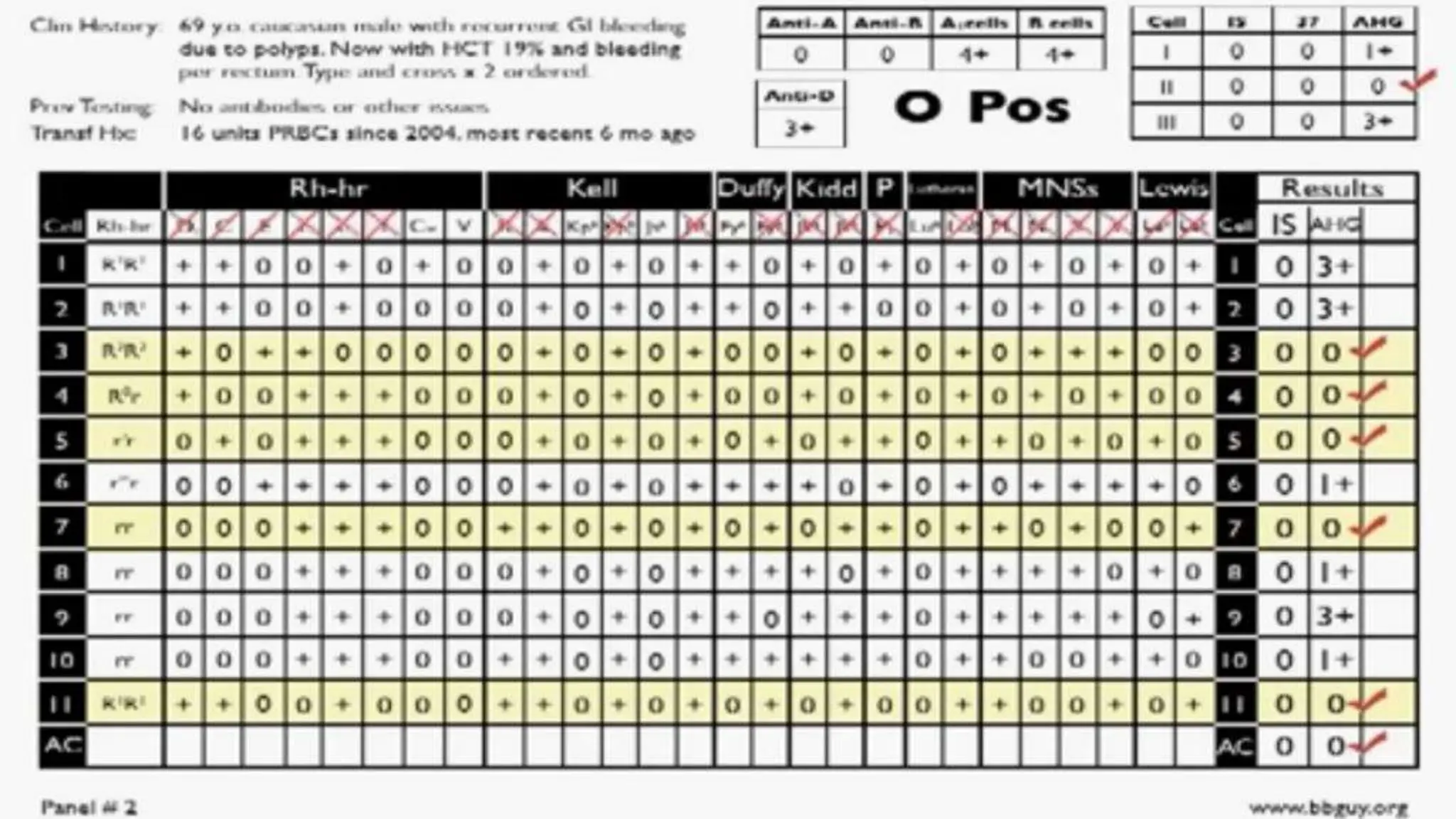 Case presentation on Antibody screening- how to solve 3 cell and 11 ...