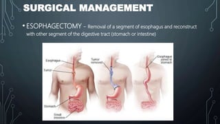 Esophageal Carcinoma | PPTX