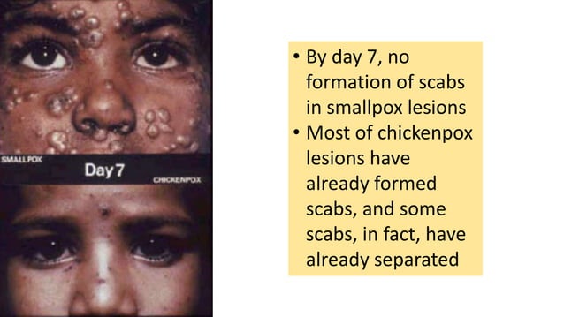 Case Presentation- A Case of Chickenpox.pptx | Skin and Dermatology ...