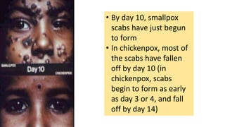 Case Presentation- A Case of Chickenpox.pptx