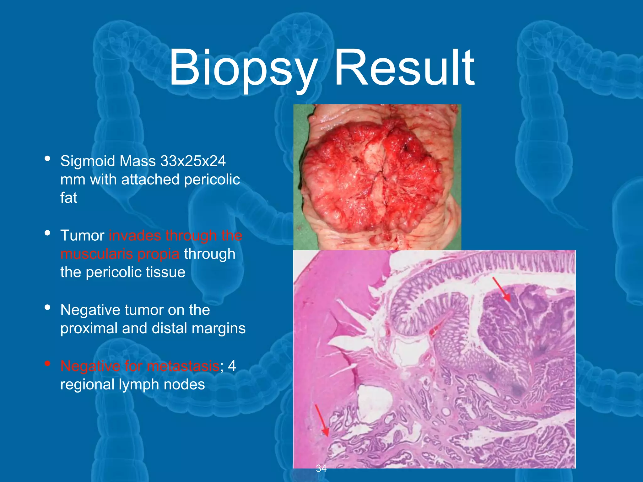 Colon Cancer - A Case Presentation | PPTX