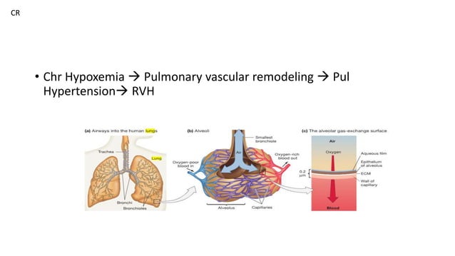 CASE PRESENTATION-COPD.ppt | Lung and Respiratory Health | Diseases and Conditions