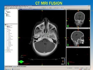 Paediatric Ependymoma (p.o) | PPTX