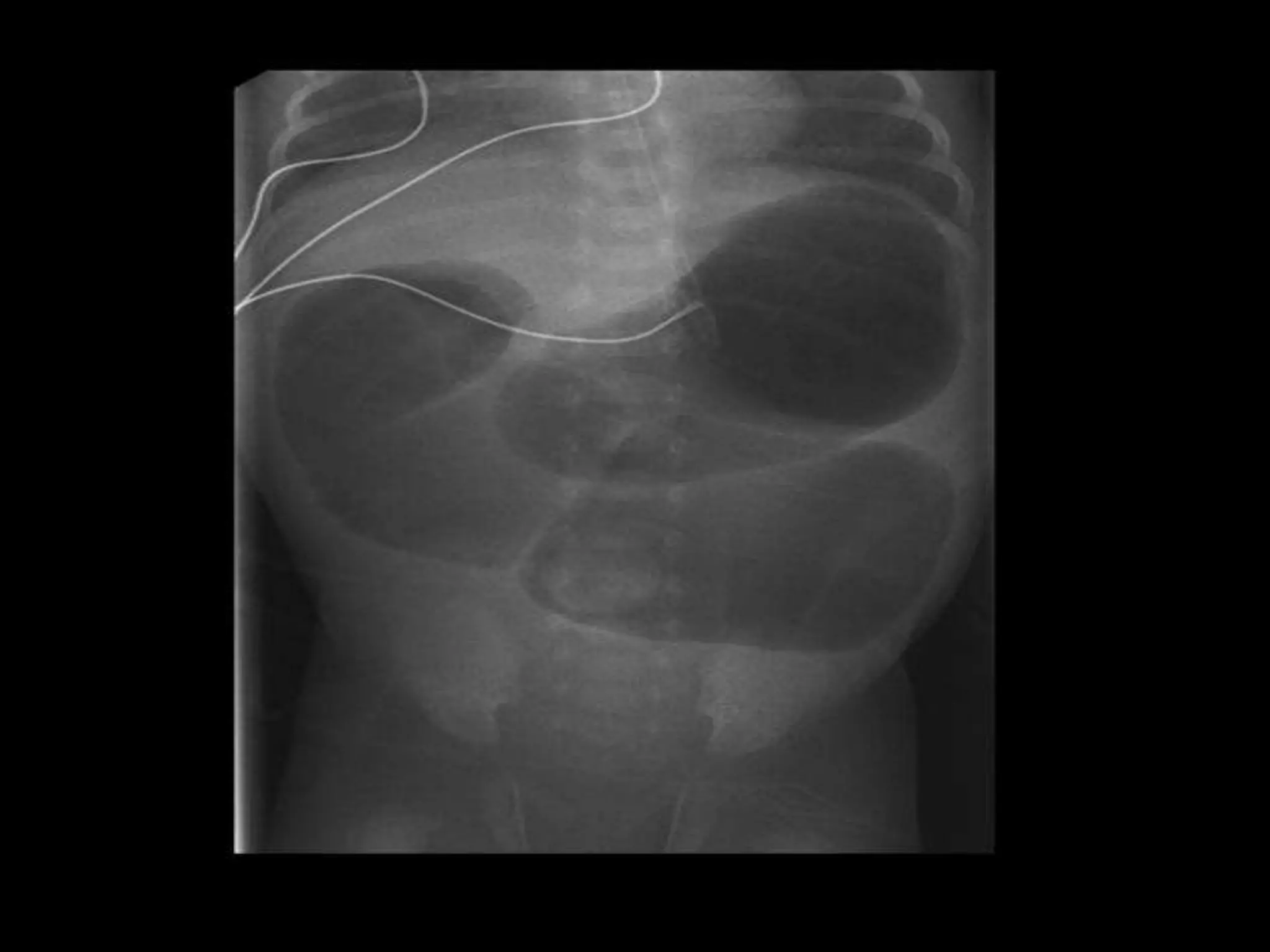 Intestinal obstruction Neonates | PPTX