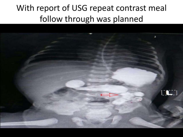 Intestinal obstruction Neonates | PPTX