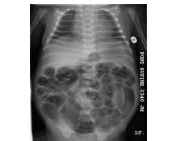 Intestinal obstruction Neonates