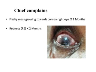 Ocular surface neoplasia (OSSN)- Case report | PPTX