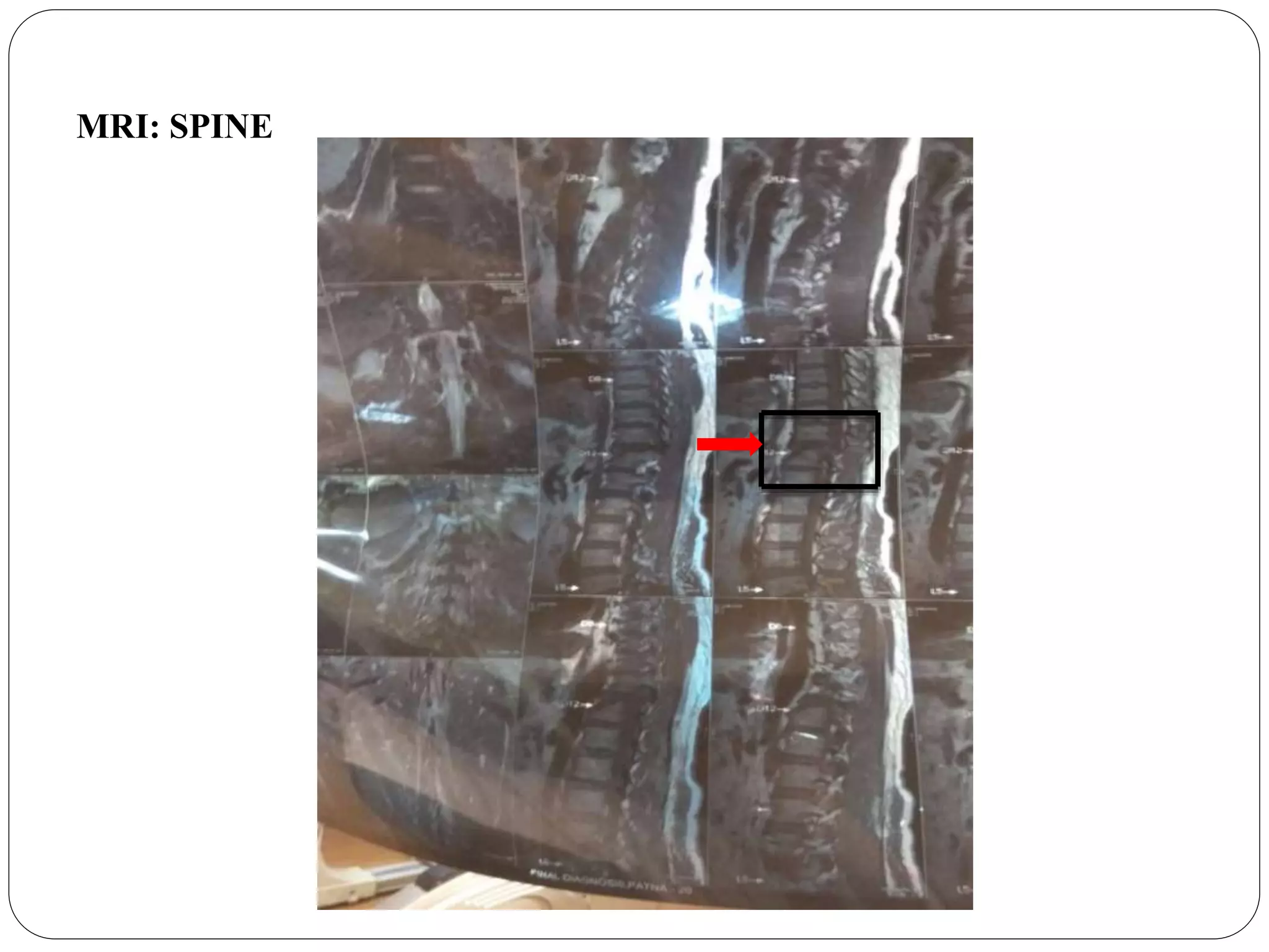 CASE PRESENTATION - SPINAL CORD INJURY BY HIMANIKAUSHIK - .pptx