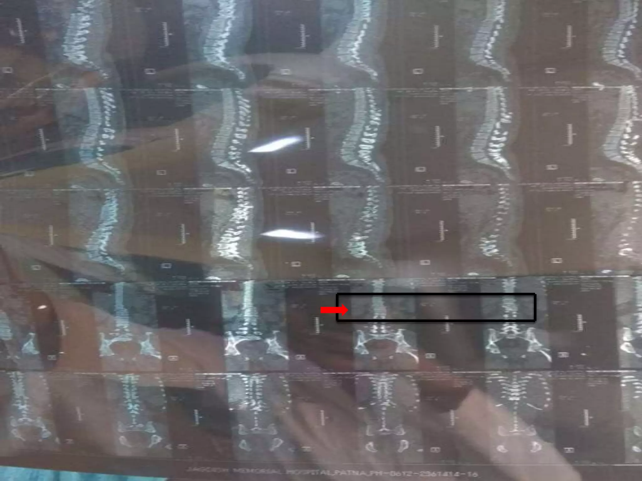 CASE PRESENTATION - SPINAL CORD INJURY BY HIMANIKAUSHIK - .pptx