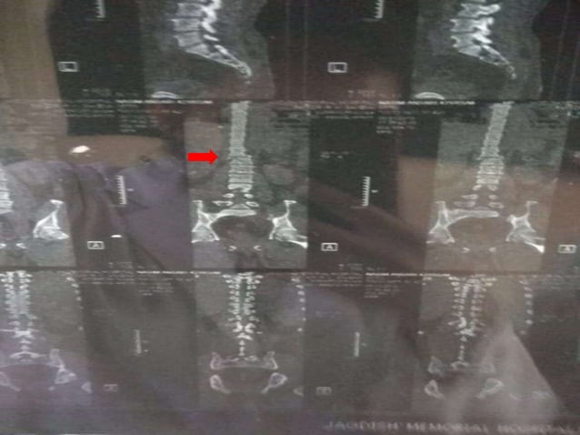 CASE PRESENTATION - SPINAL CORD INJURY BY HIMANIKAUSHIK - .pptx