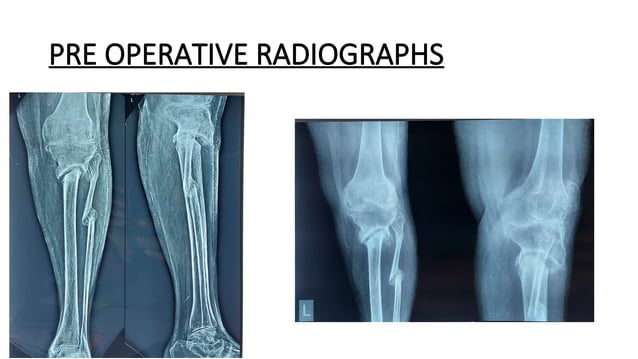 CASE PRESENTATION- hOW TO PERFORM total knee replacement surgery in ...