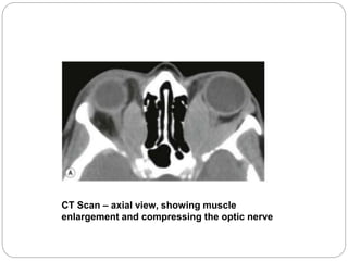 Thyroid Eye Disease - Case and Discussion | PPTX