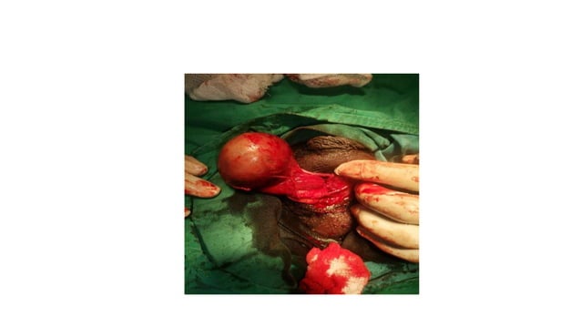 Case Presentation Testicular Torsion Pptx