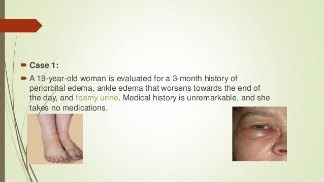 Generalized Edema Generalized And Localized Edema: A Clinical