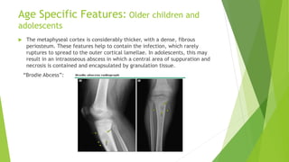 Osteomyelitis in Children | PPTX