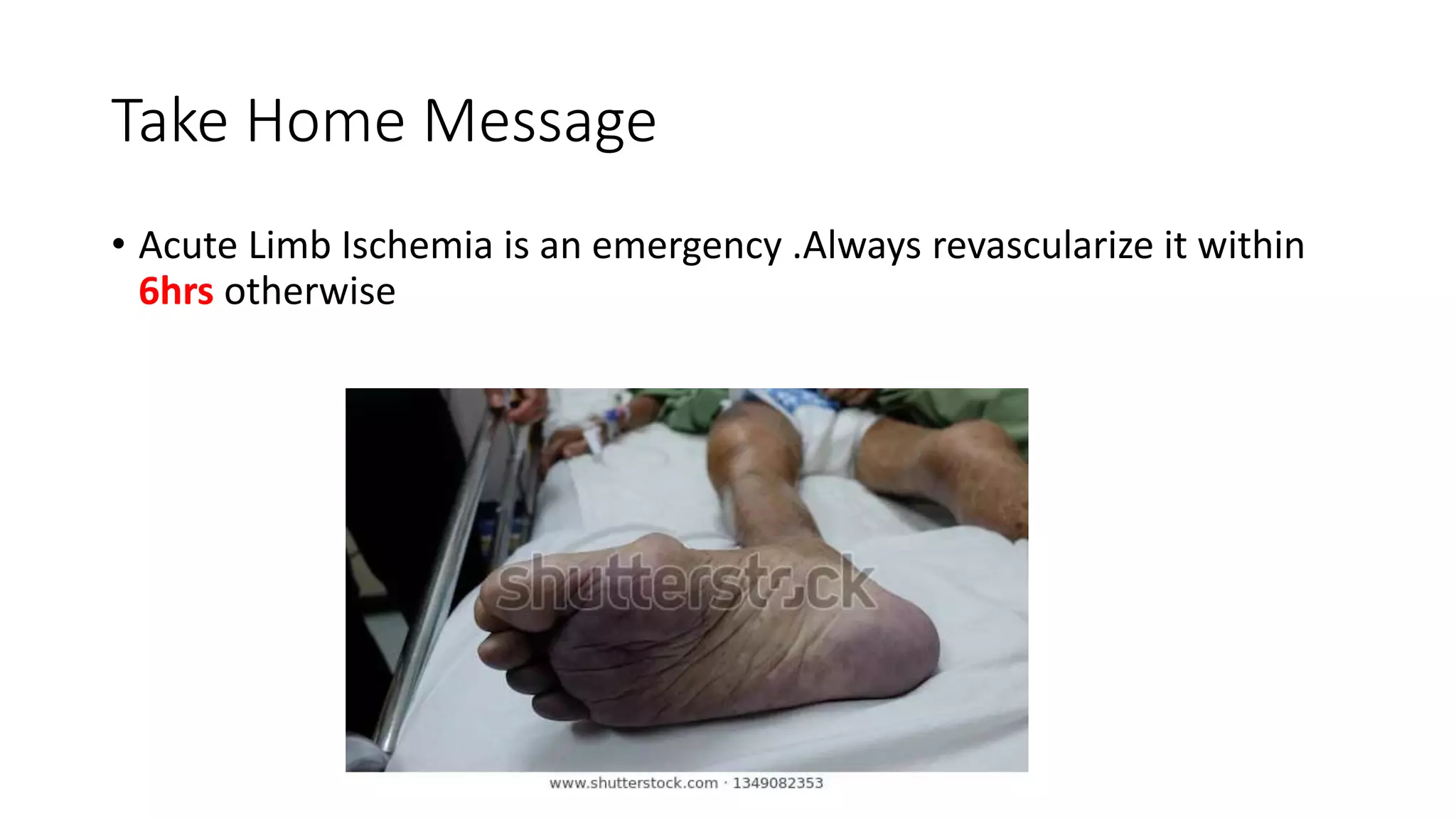 Acute Limb Ischemia | PPTX