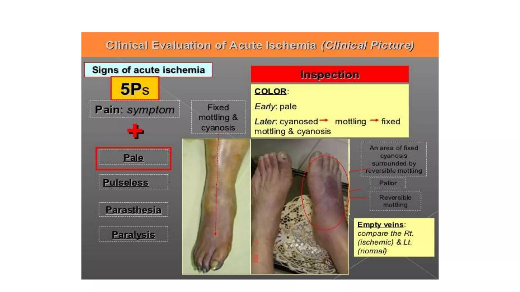 Acute Limb Ischemia | PPTX