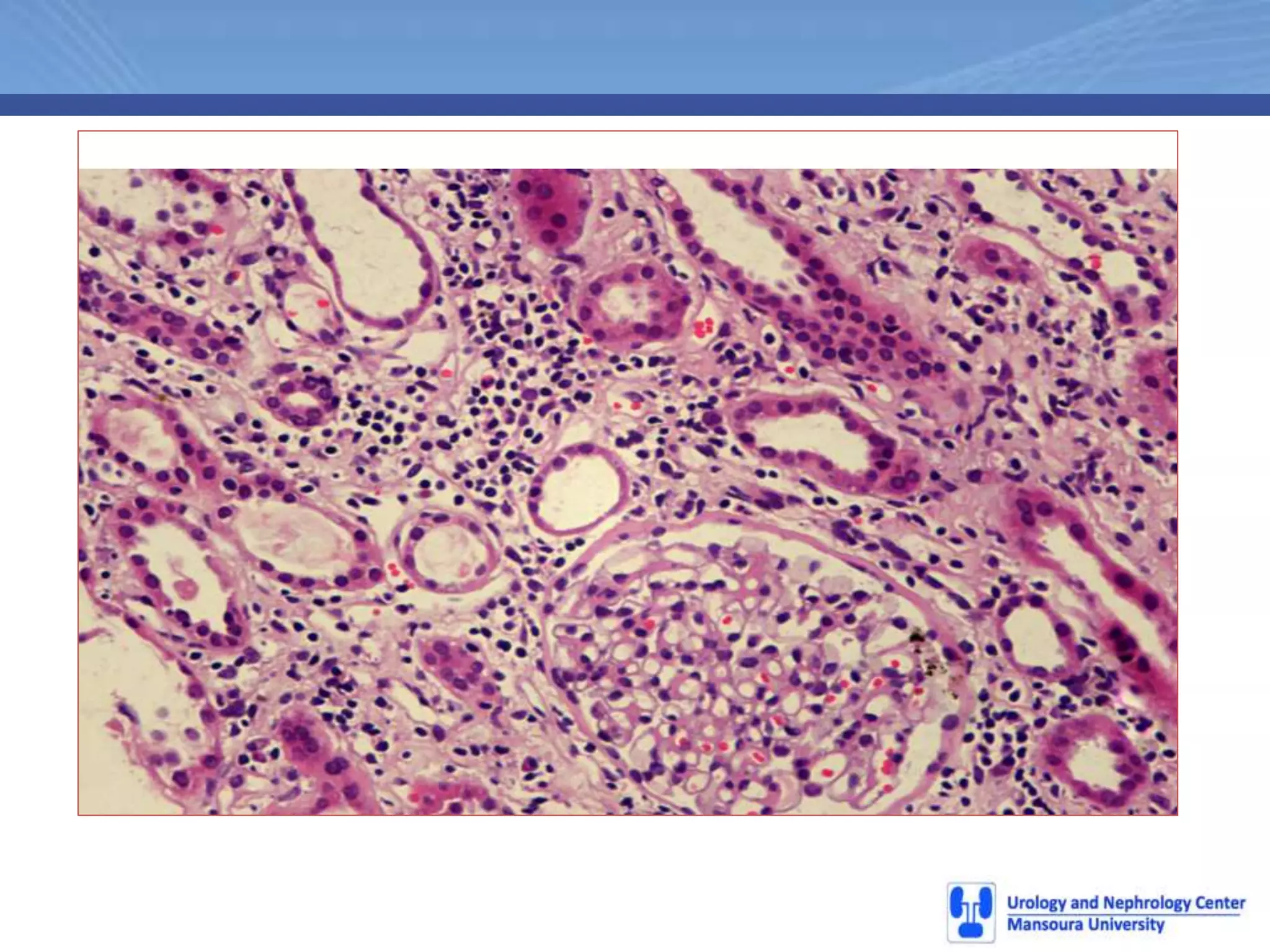 Acute interstitial nephritis | PPTX