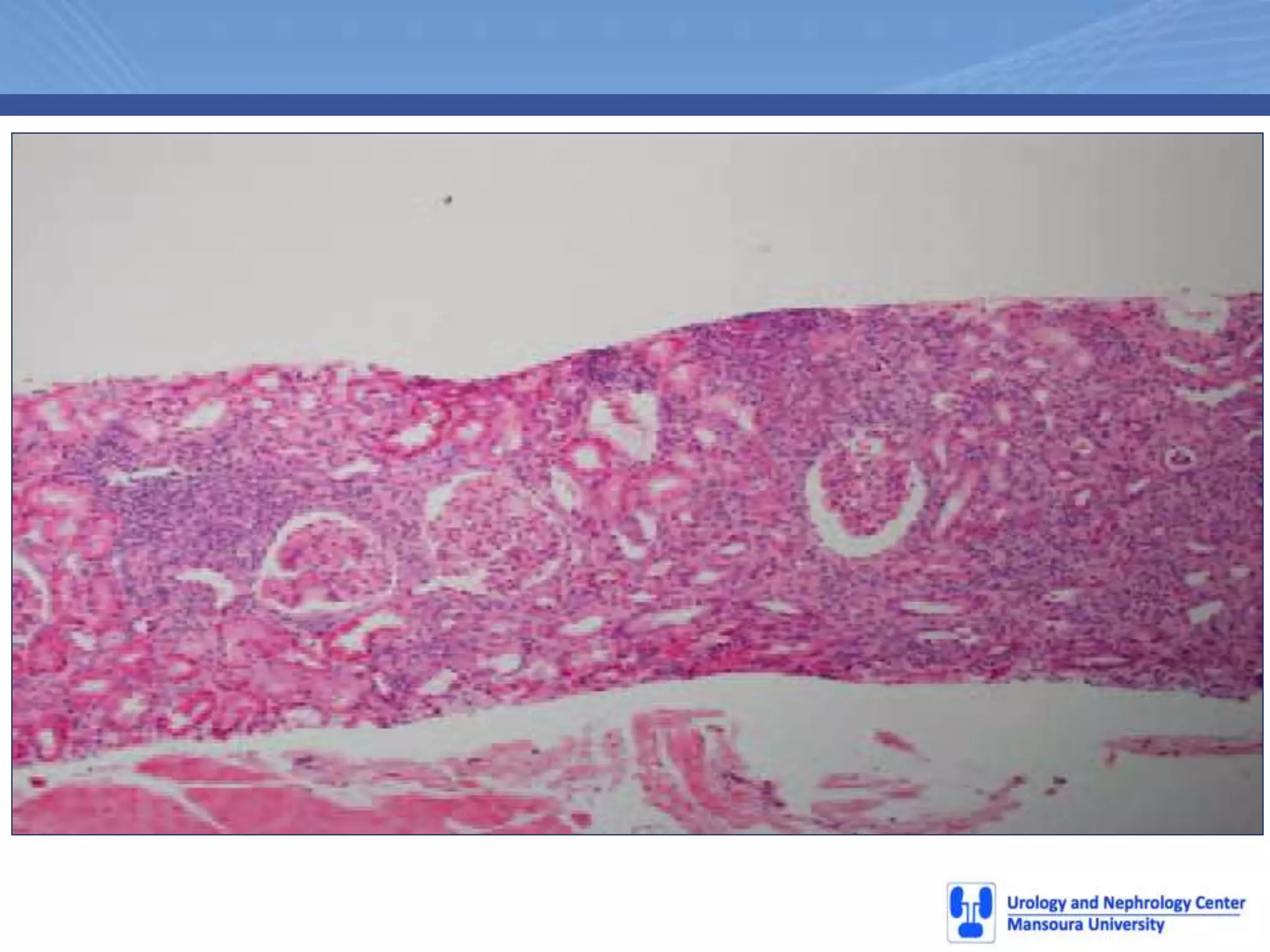 Acute interstitial nephritis | PPTX