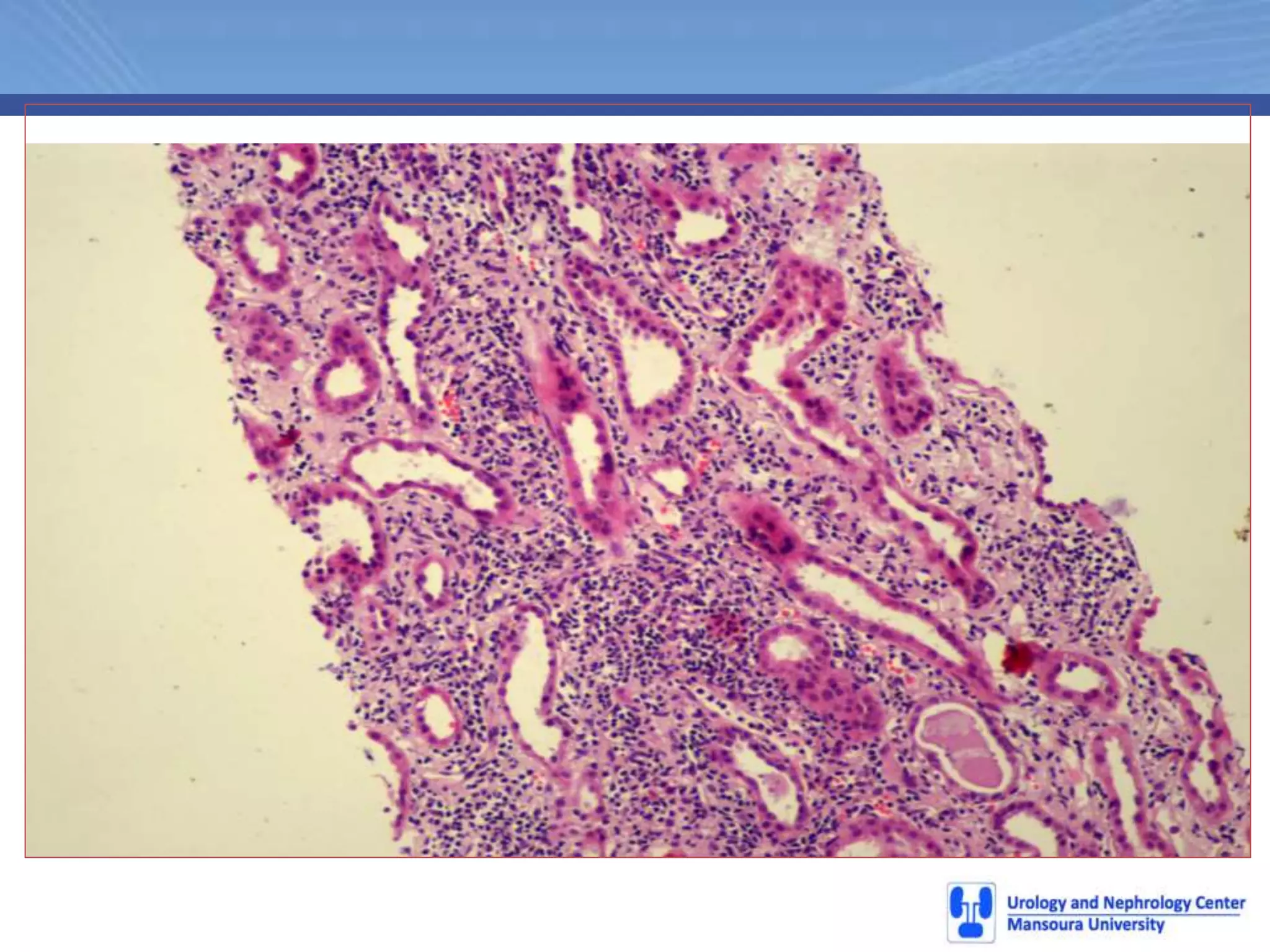 Acute interstitial nephritis | PPTX