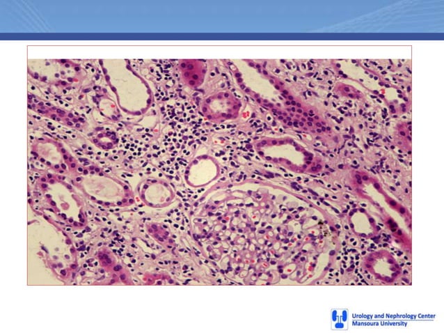 Acute interstitial nephritis | PPTX