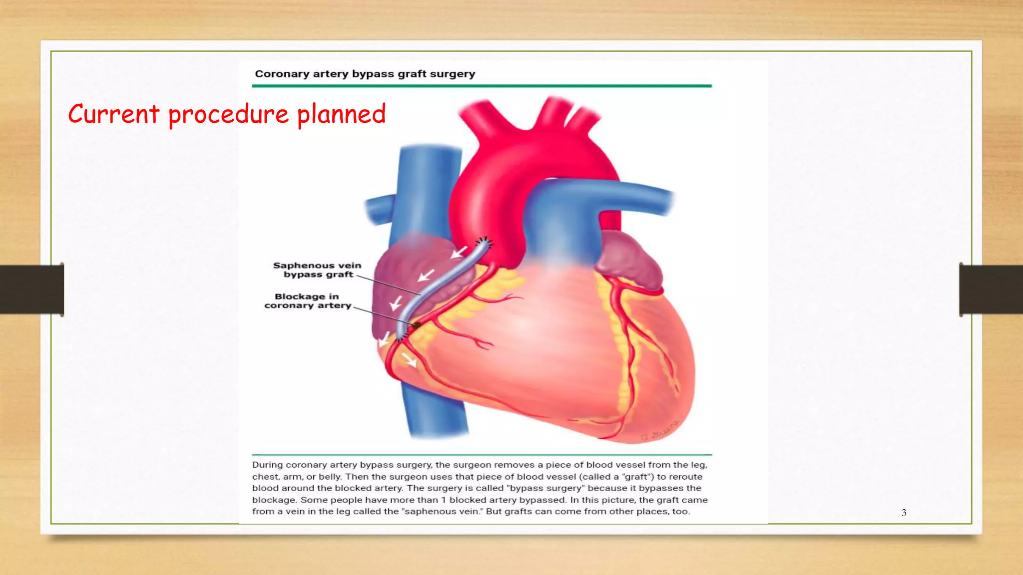 Case study on CABG surgery | PPTX