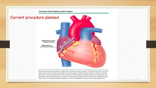Case study on CABG surgery | PPT