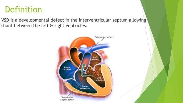 Case presentation of ventricular septal defect VSD 30 4-2019 | PPTX ...