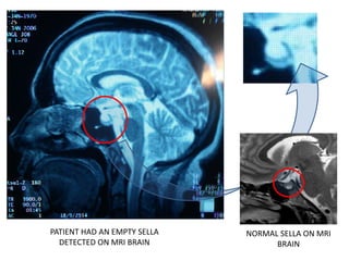 GRAND ROUNDS : Anterior ischemic optic neuropathy with empty sella | PPTX